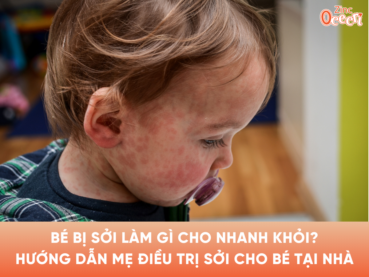 Bé bị sởi làm gì cho nhanh khỏi? Hướng dẫn mẹ điều trị sởi cho bé tại ...